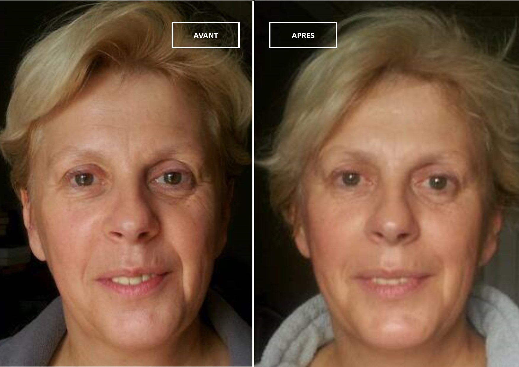Kobido Soin Anti Age Efficace Avant Et Quatre Semaines Après Le Clos Eden Institut De Beauté